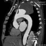 Abdominal Aortic Aneurysm (AAA) - Vascular Care WA